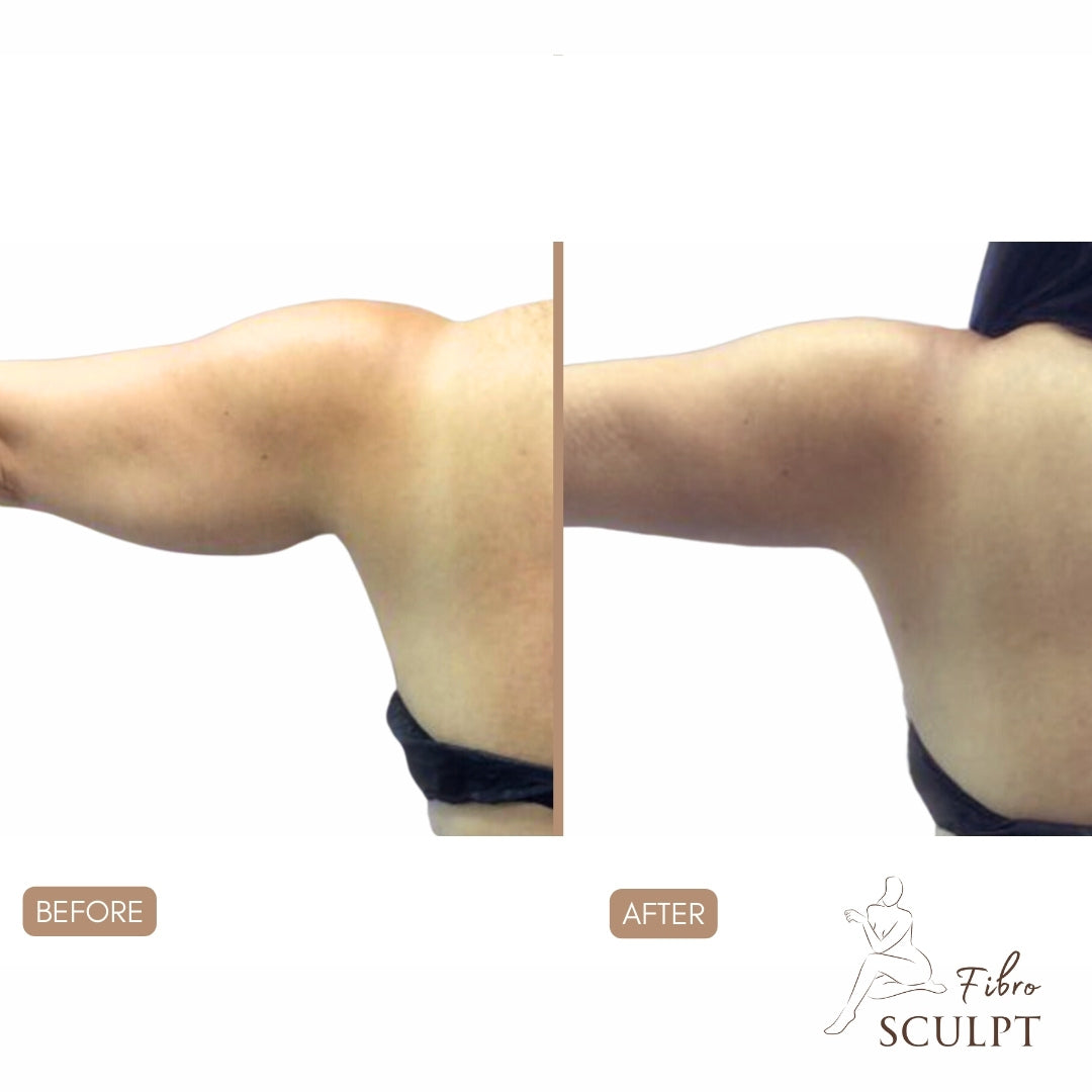 Before + After: CELLULITE + BODY CONTOURING + SKIN TIGHTENING – FibroSculpt